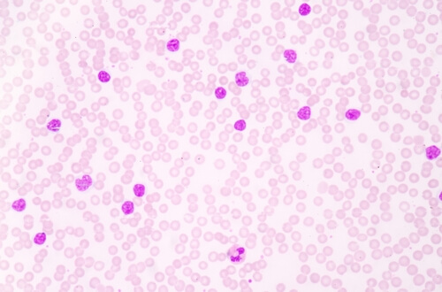 Новый лазер распознает и убивает клетки меланомы | Лечение в Израиле ...